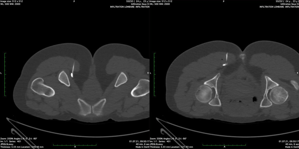 Infiltration canal d’alcock à Genève