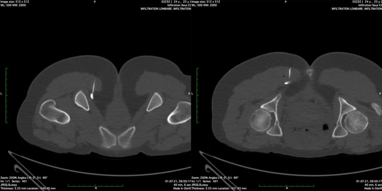 Infiltration canal d’alcock à Genève
