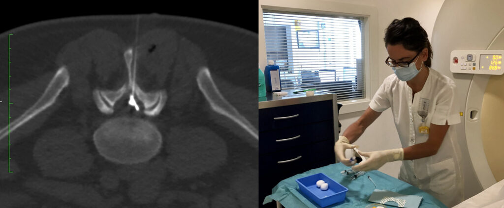 Infiltration lombaire épidurale à Genève (voie trans facettaire sous CT ...