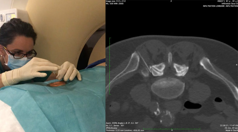 Infiltration rachidienne foraminale à Genève sous CT Scan
